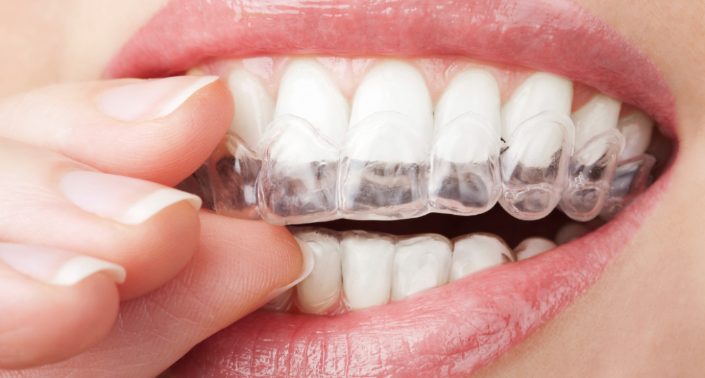 Why Should I Visit An Invisalign Diamond Provider? QDC Team